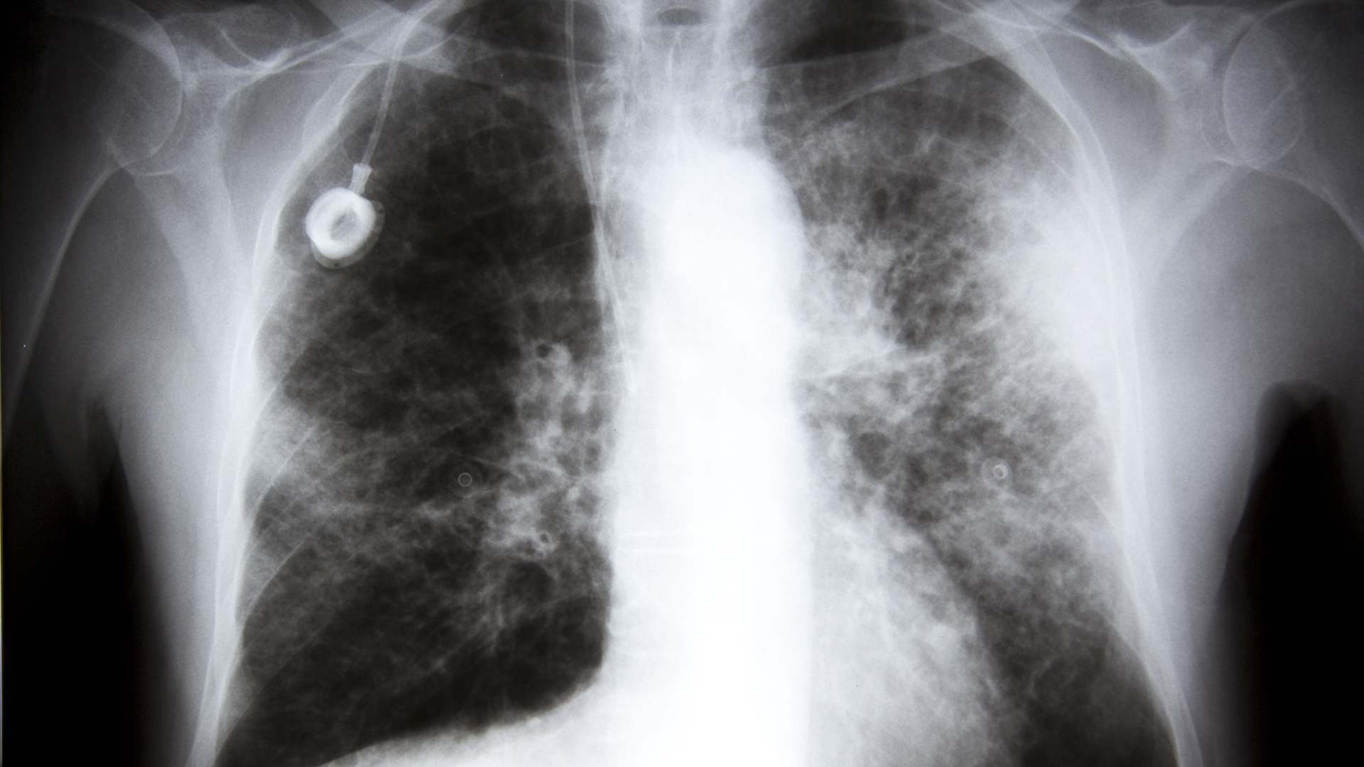 Daily Dose Treating Stage IV Lung Cancer With A Pill Daily Dose Treating Stage IV Lung Cancer With A Pill